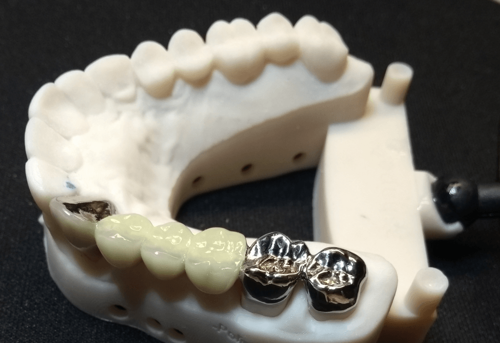 Crown & Bridge - Dental Lab Edmonton | Digital Crown & Bridge ...